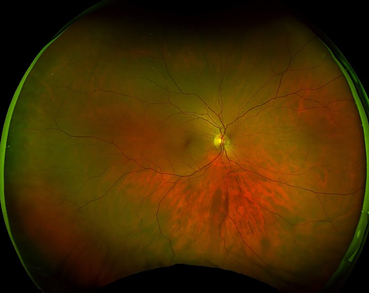 Optomap Retinal Exam - Giles Eye Care Portland, ME